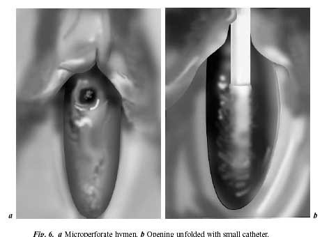 microperforate hymenectomy